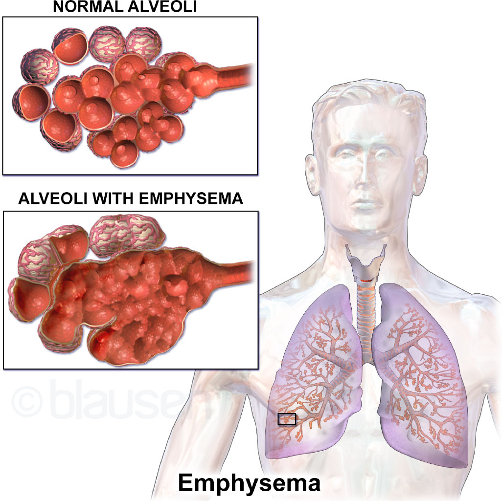 Respiratory Health and Disorders Tutorial | Sophia Learning